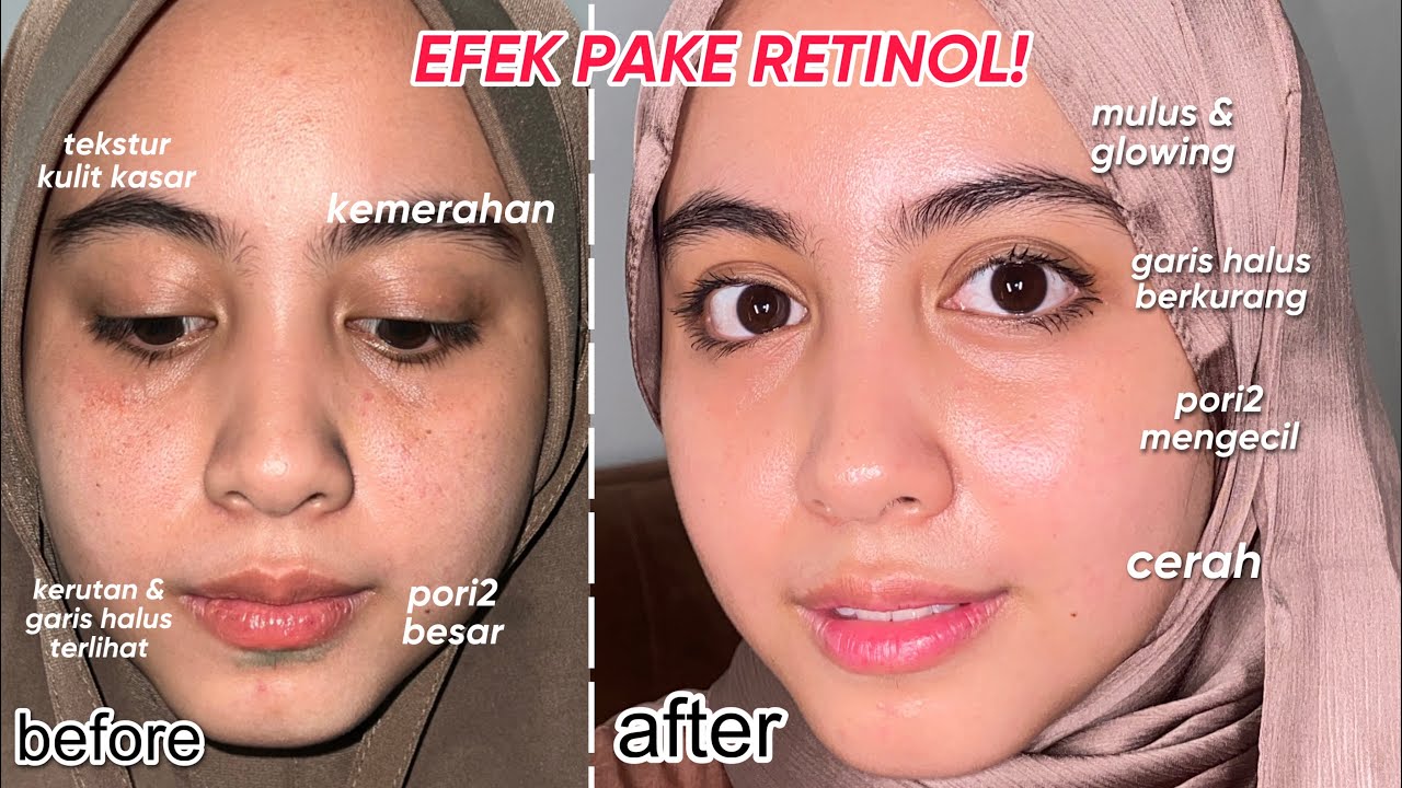 4 Cara Memakai Retinol yang Benar Supaya Wajah Cepat Glowing – Radar Pekalongan ID