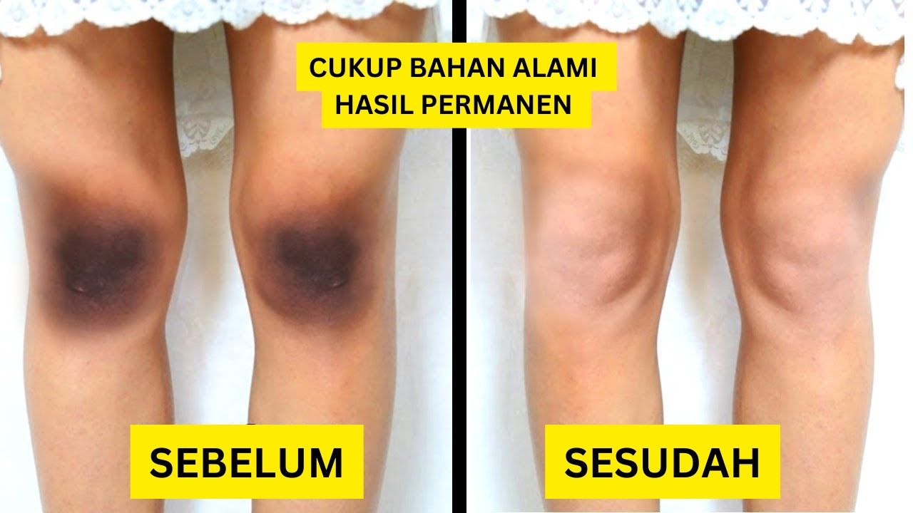 Wow, Gratis! 5 Cara Menghilangkan Lutut Hitam Paling Ampuh yang Wajib ...