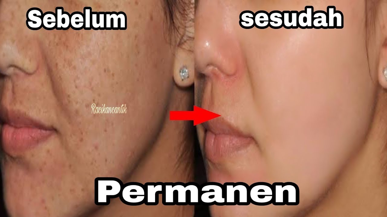 5 Produk Paket Viva untuk Flek Hitam, Asli Ampuh Tanpa Efek Samping ...