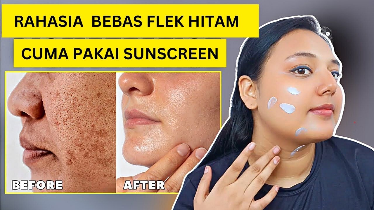 Apakah Sunscreen Bisa Menghilangkan Flek Hitam? Simak, Jawaban dan 5 ...