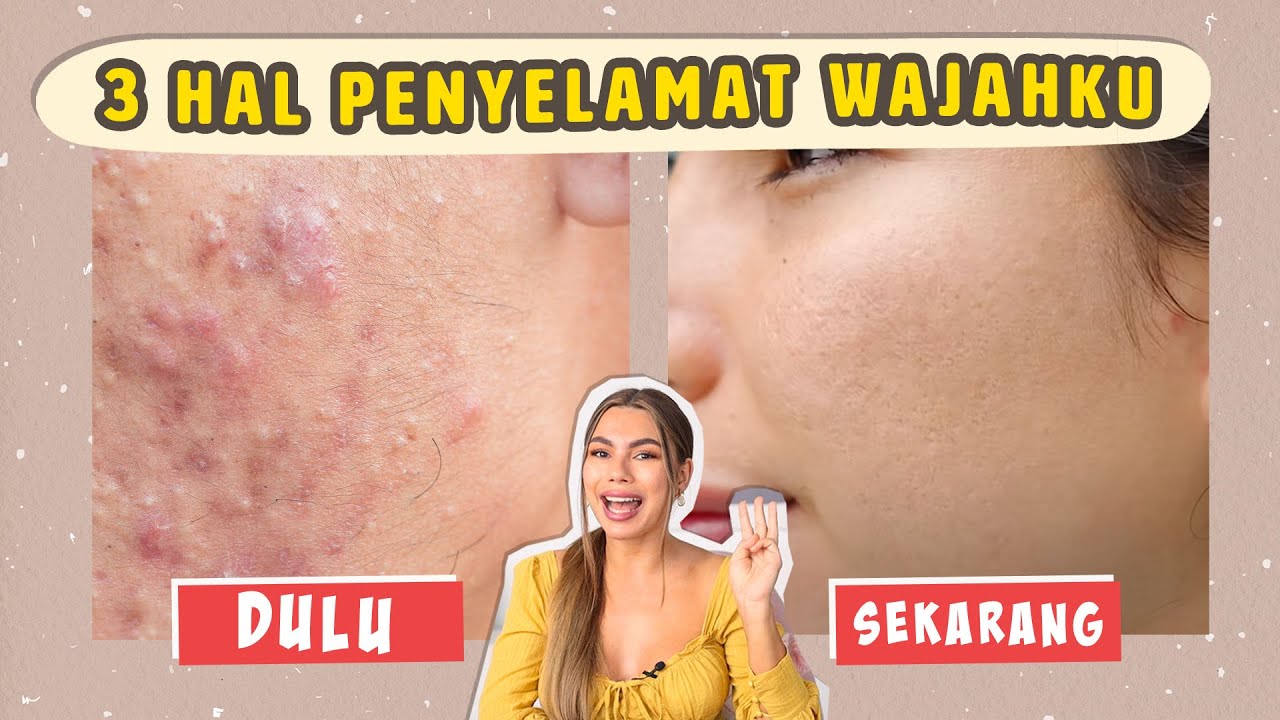 Inilah 3 Cara Menghilangkan Jerawat Secara Permanen dengan Cepat, Rahasia Wajah Mulus Tanpa Noda ...