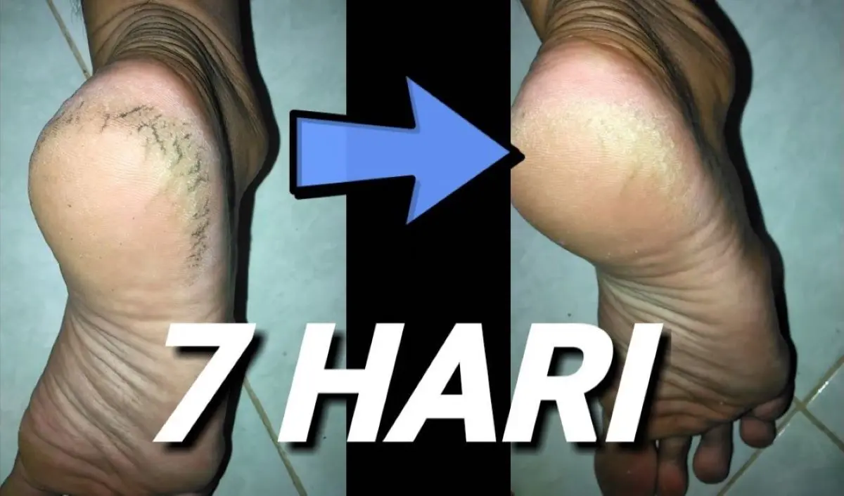 Cara Mengatasi Tumit Pecah-Pecah, Tambahkan 1 Bahan Ini dengan Air Buah ...